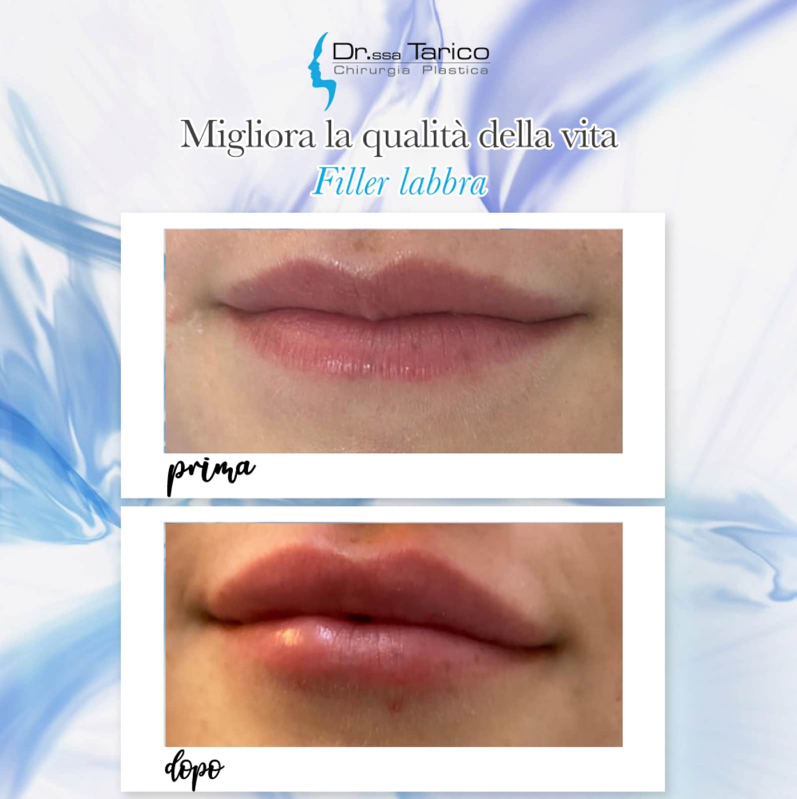 Prima e dopo Filler | Chirurgia Plastica - Catania - Sicilia