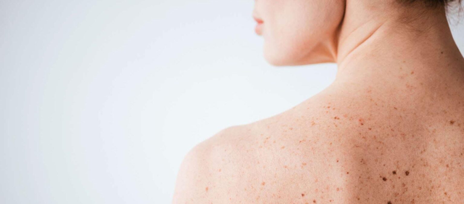 Rimozione nei (o nevi) | Chirurgia Plastica - Catania - Sicilia