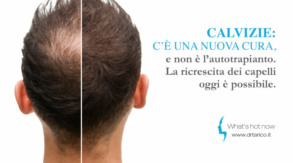 Calvizie: c'è una nuova cura, e non è l'autotrapianto. | Chirurgia ...