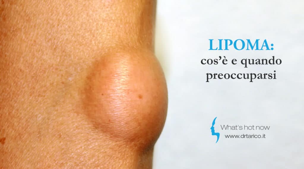 Lipoma: cos'è e quando preoccuparsi | Chirurgia Plastica - Catania ...